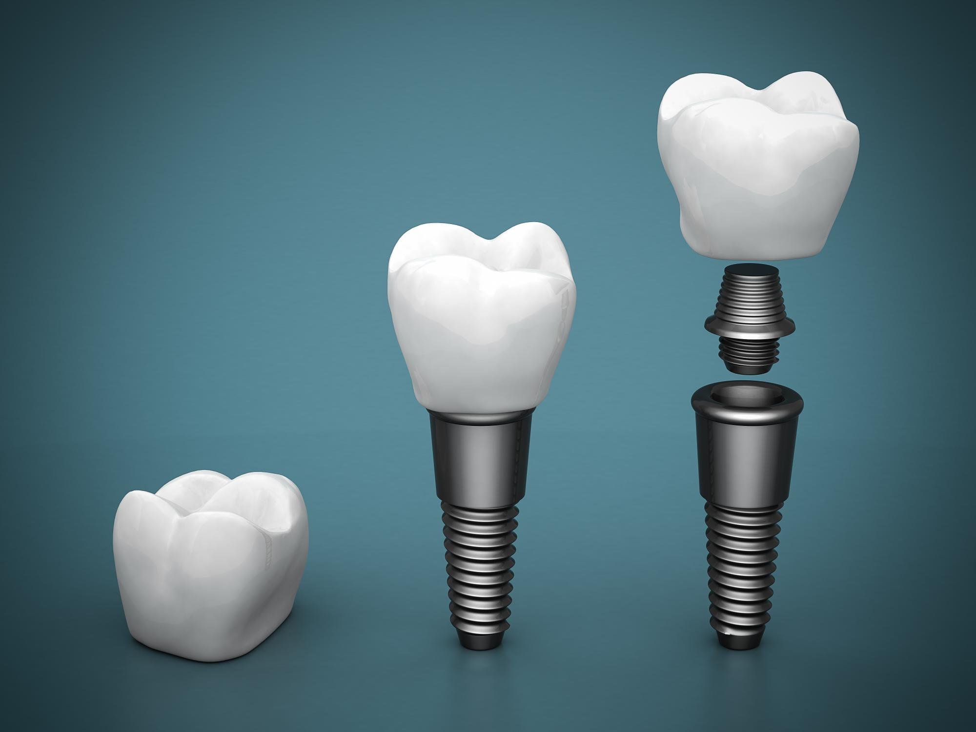 Are dental implants the long-term solutions to your missing teeth?
